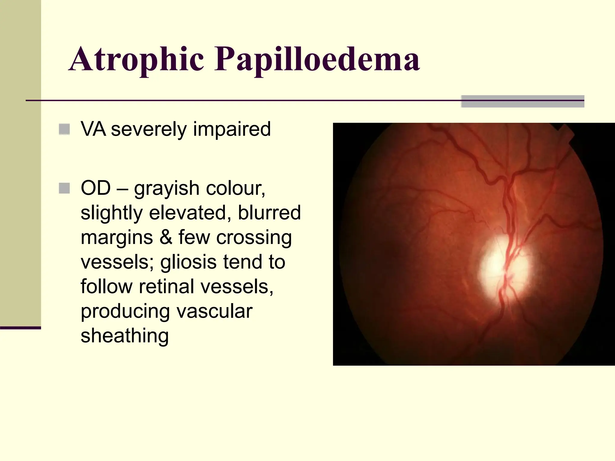 3. PAPILLOEDEMA Neuro Ophthalmology0.ppt