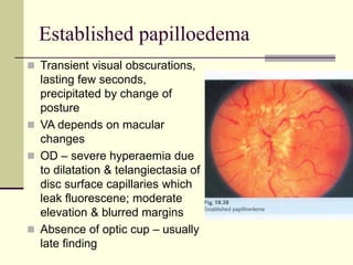 3. PAPILLOEDEMA Neuro Ophthalmology0.ppt