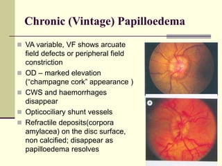 3. PAPILLOEDEMA Neuro Ophthalmology0.ppt