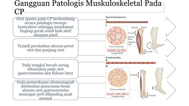 3. Patologi Muskuloskeletal Pada Cerebral Palsy.pptx