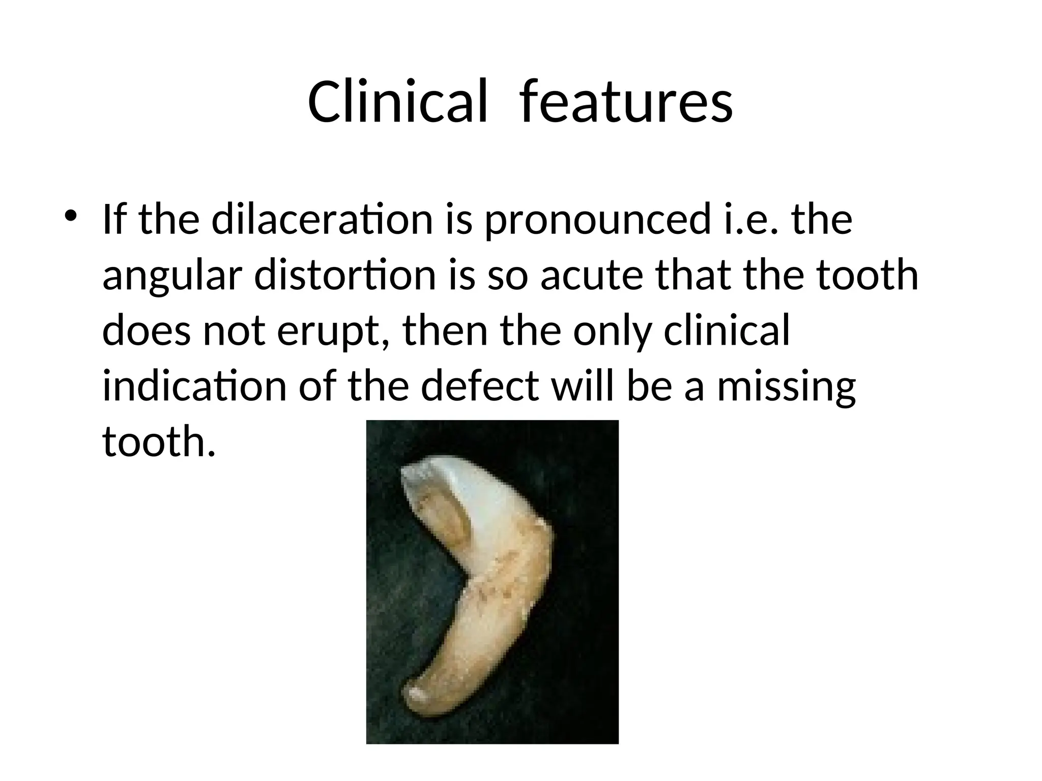 3. MANAGMENT OF TOOTH DILACERATION WITH MANDIBULAR MOLAR.ppt