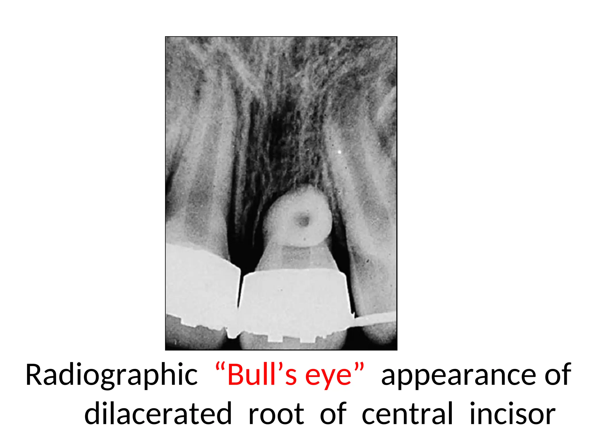 3. MANAGMENT OF TOOTH DILACERATION WITH MANDIBULAR MOLAR.ppt