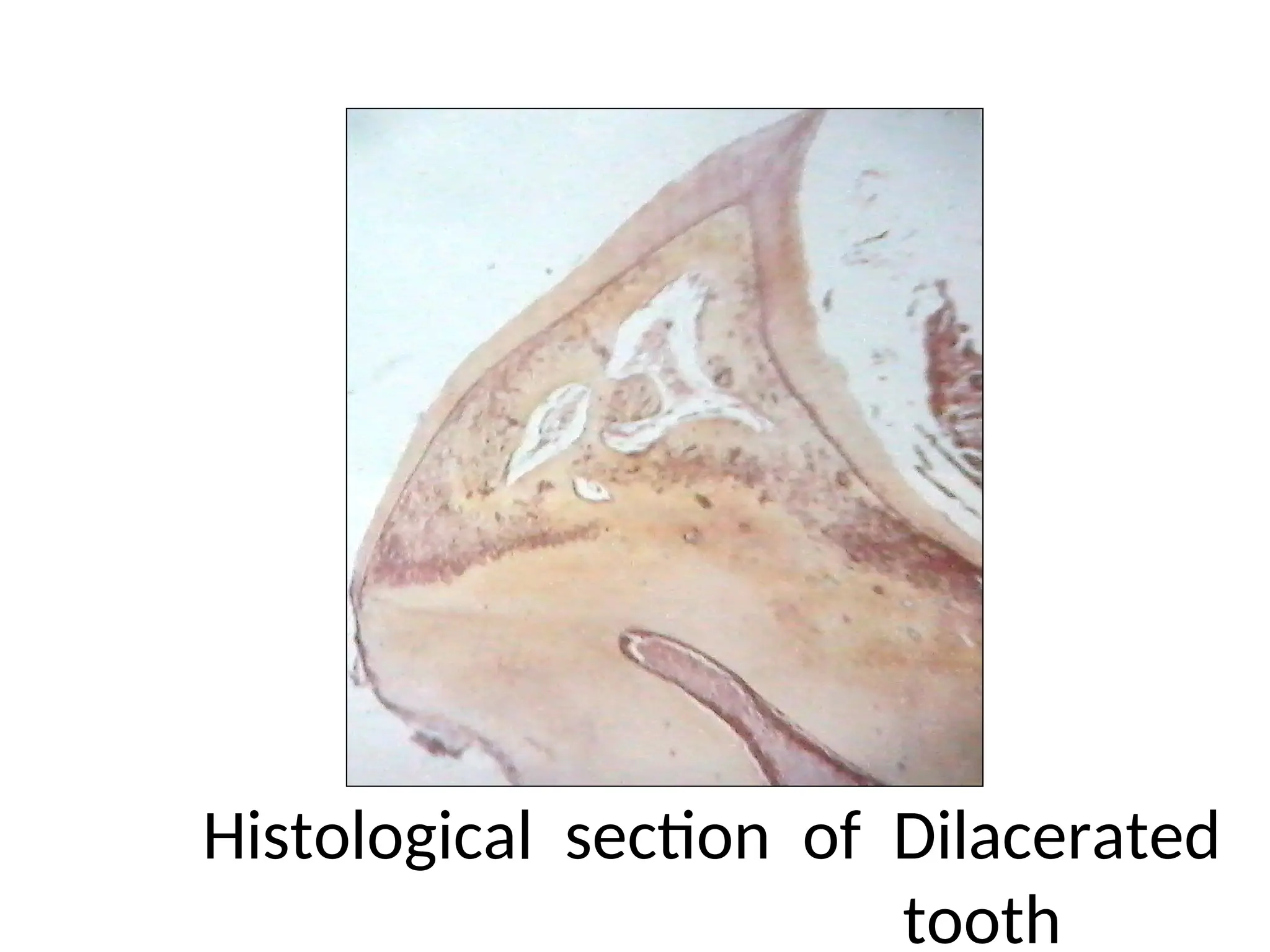 3. MANAGMENT OF TOOTH DILACERATION WITH MANDIBULAR MOLAR.ppt