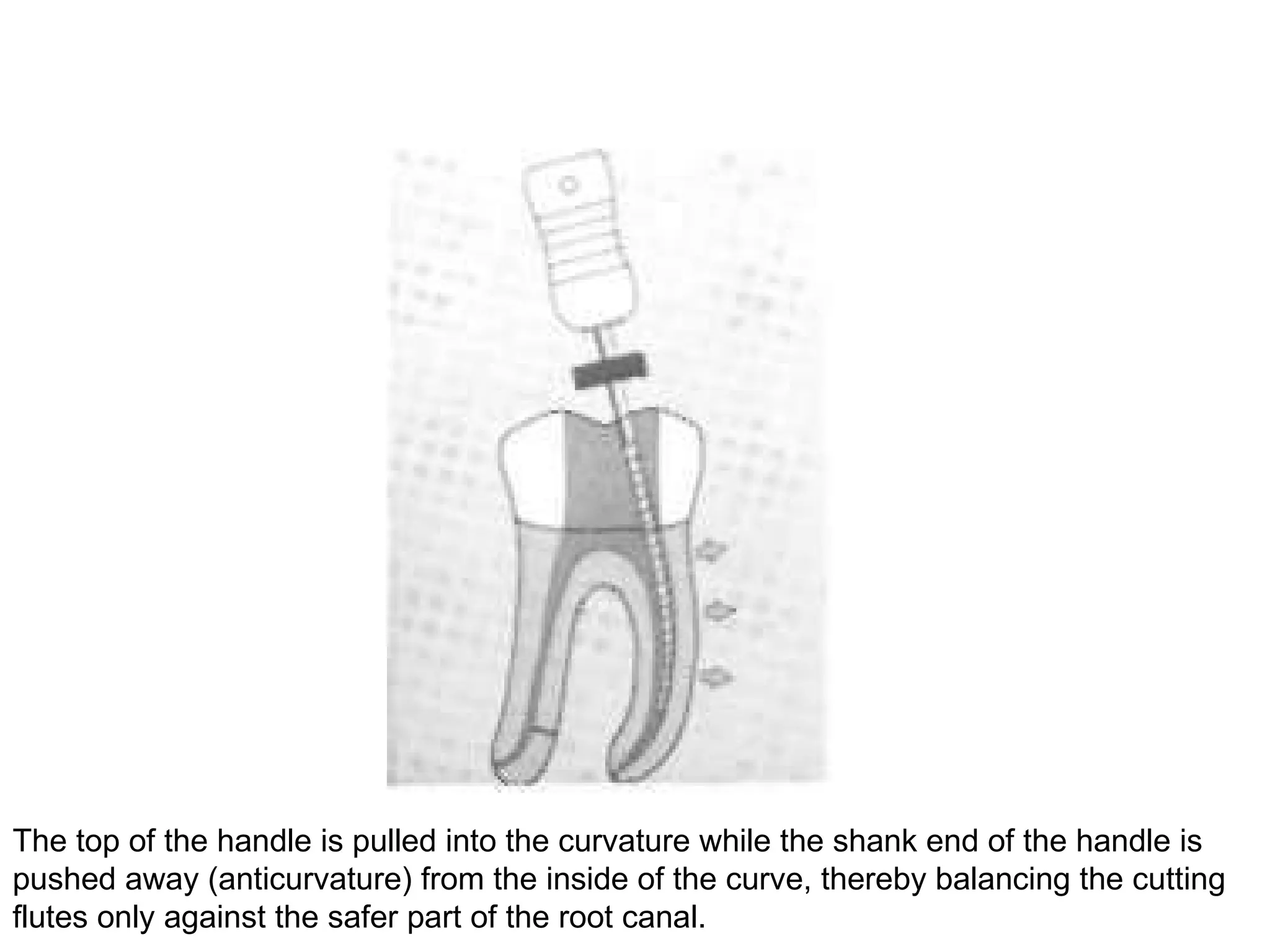 3. MANAGMENT OF TOOTH DILACERATION WITH MANDIBULAR MOLAR.ppt