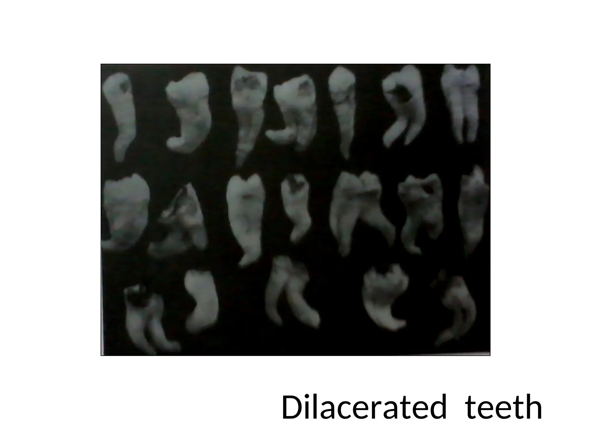 3. MANAGMENT OF TOOTH DILACERATION WITH MANDIBULAR MOLAR.ppt