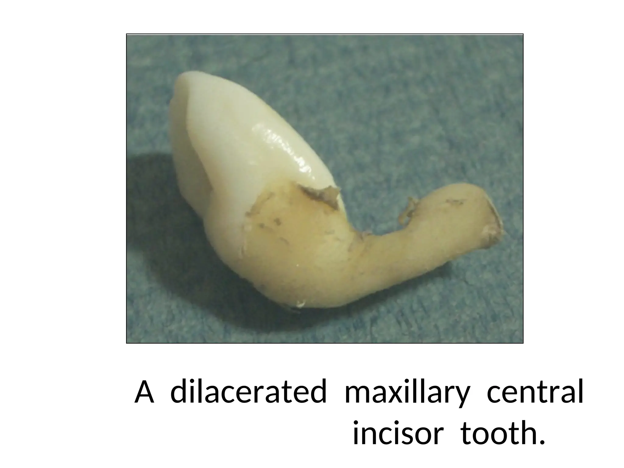 3. MANAGMENT OF TOOTH DILACERATION WITH MANDIBULAR MOLAR.ppt