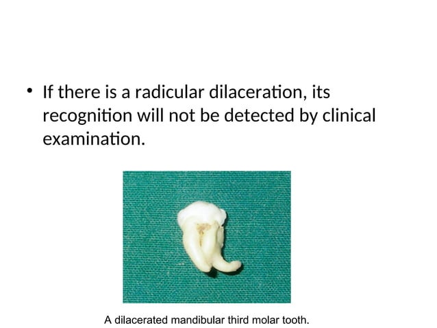 3. MANAGMENT OF TOOTH DILACERATION WITH MANDIBULAR MOLAR.ppt