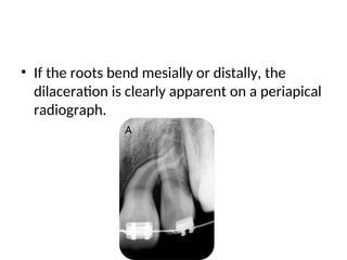 3. MANAGMENT OF TOOTH DILACERATION WITH MANDIBULAR MOLAR.ppt