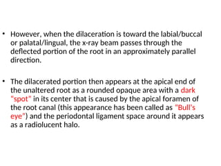 3. MANAGMENT OF TOOTH DILACERATION WITH MANDIBULAR MOLAR.ppt