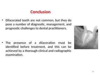 3. MANAGMENT OF TOOTH DILACERATION WITH MANDIBULAR MOLAR.ppt
