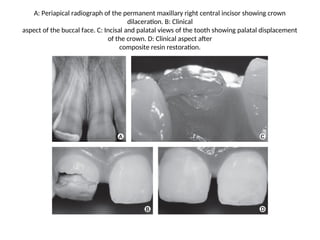 3. MANAGMENT OF TOOTH DILACERATION WITH MANDIBULAR MOLAR.ppt