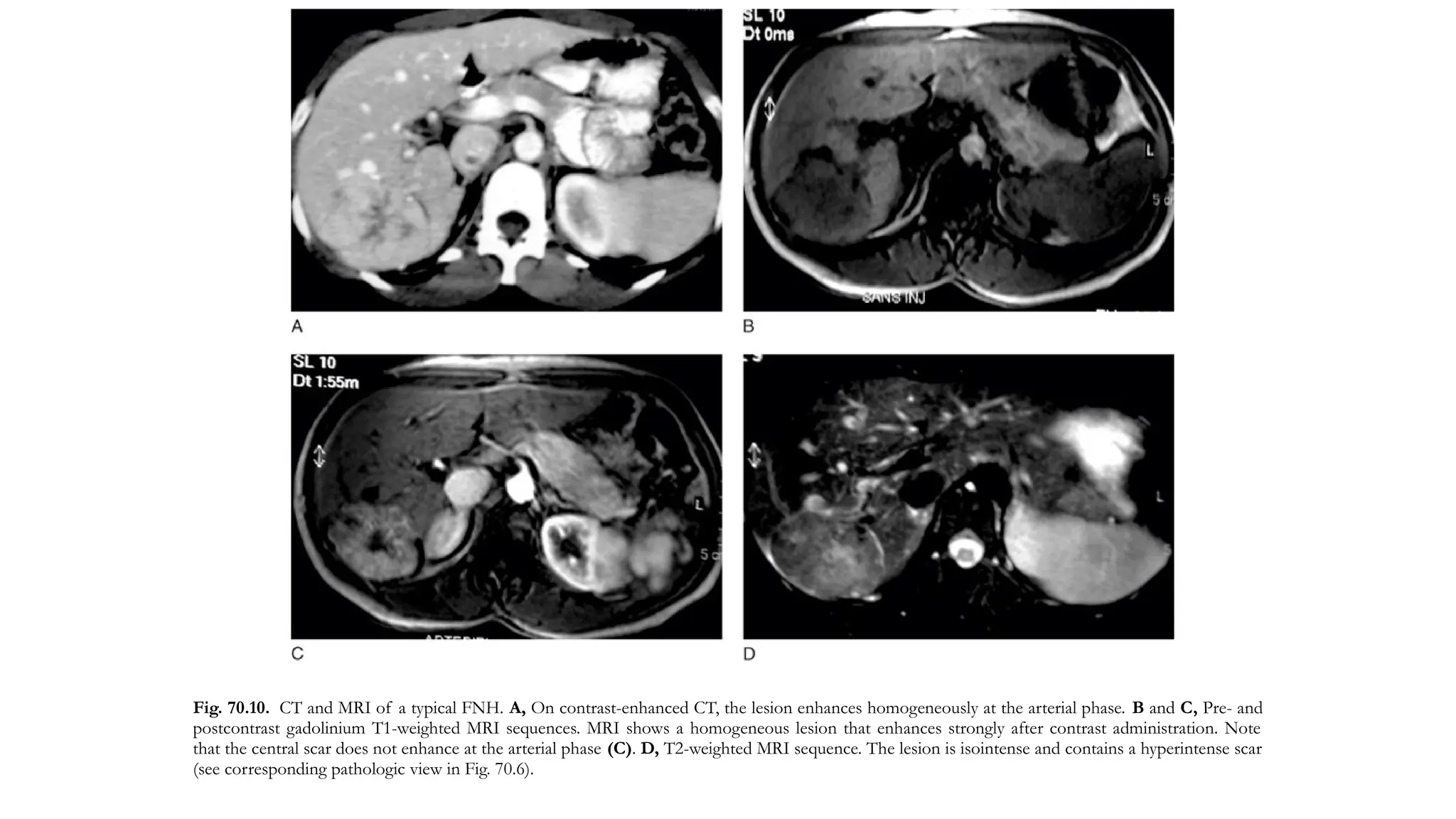 3. Benign liver tumors (General Surgery)=.pptx