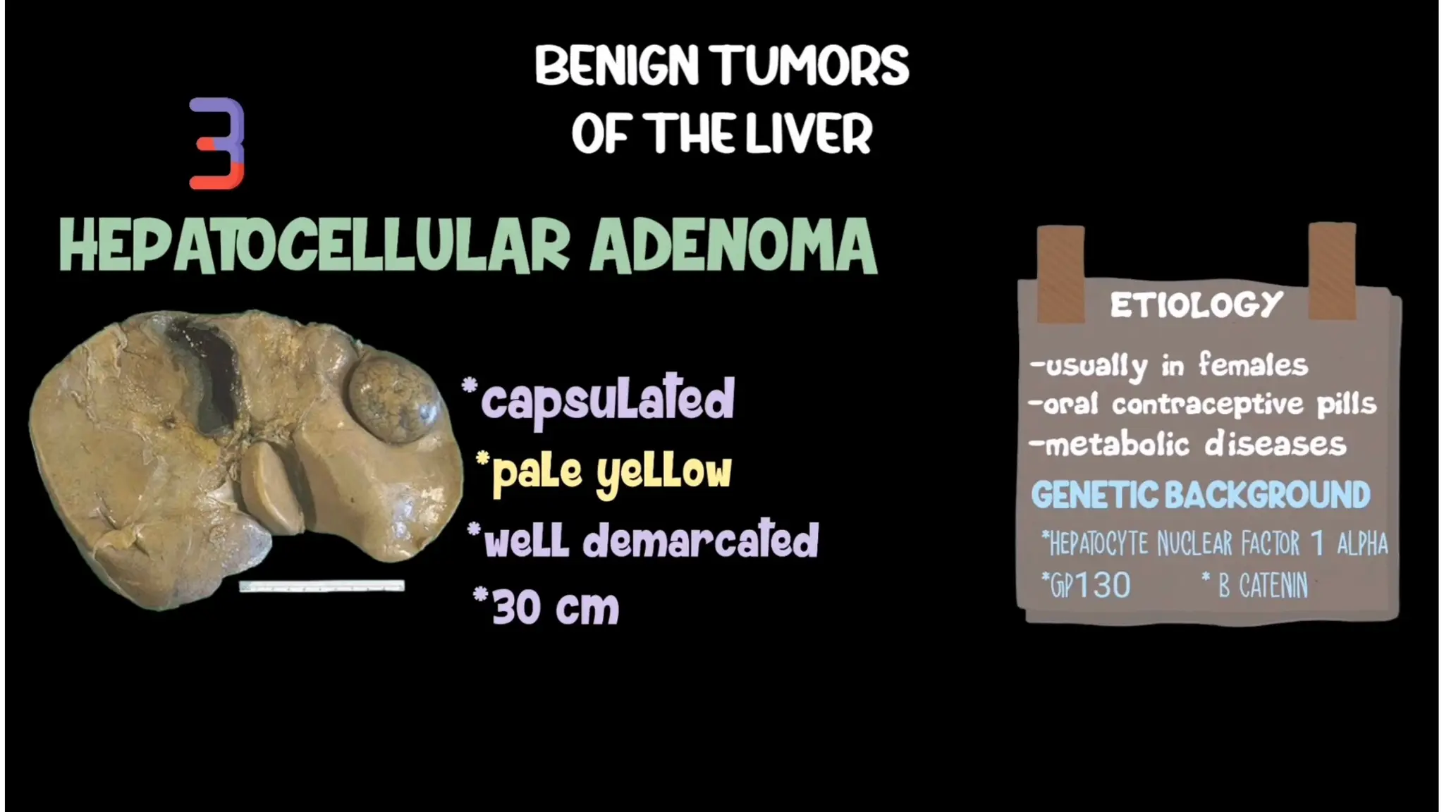 3. Benign liver tumors (General Surgery)=.pptx