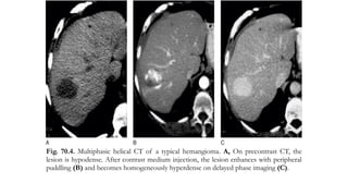 3. Benign liver tumors (General Surgery)=.pptx
