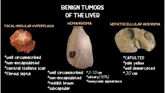 3. Benign liver tumors (General Surgery)=.pptx