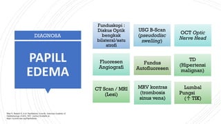 3. Papilledema mobil rusak kecebur .pptx