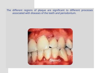 3. Etiology and pathogenesis of periodontal disease.pptx