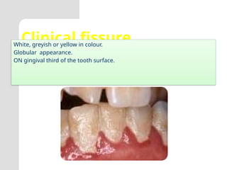 3. Etiology and pathogenesis of periodontal disease.pptx