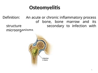 3. Osteomyelitis in children for mbbs students | PPTX