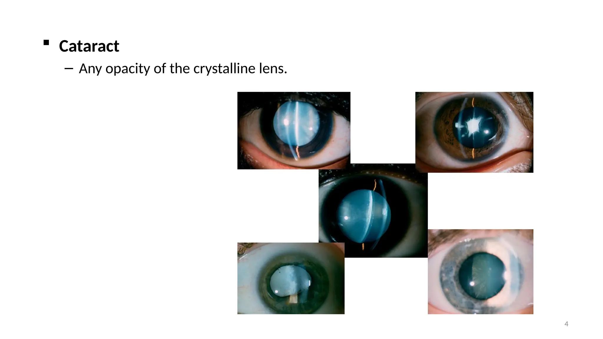 3. Cataract from Gambella University.ppt