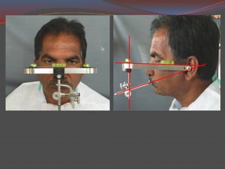 Face bow transfer semi adjustable complete denture | PPTX