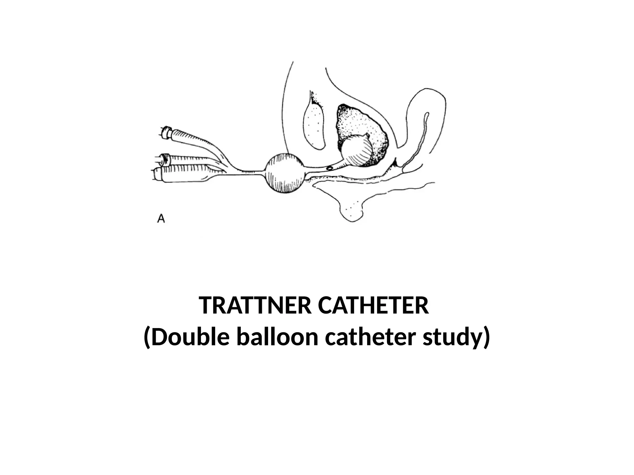 A retrograde urethrogram (RUG) urology ppt | PPTX
