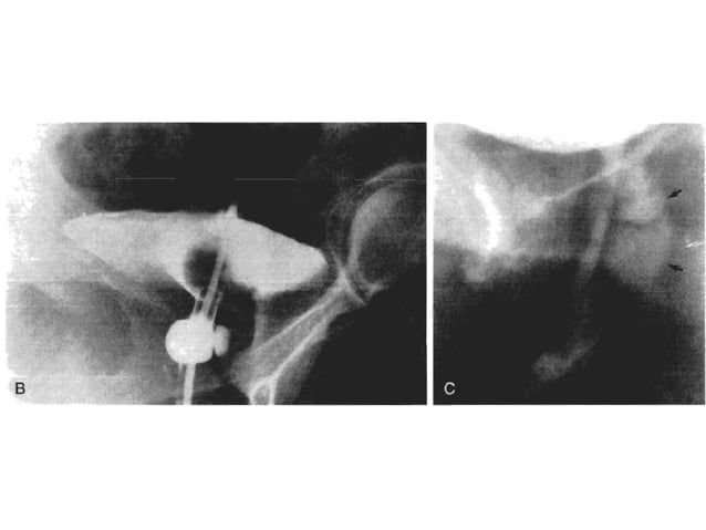 A retrograde urethrogram (RUG) urology ppt | PPT