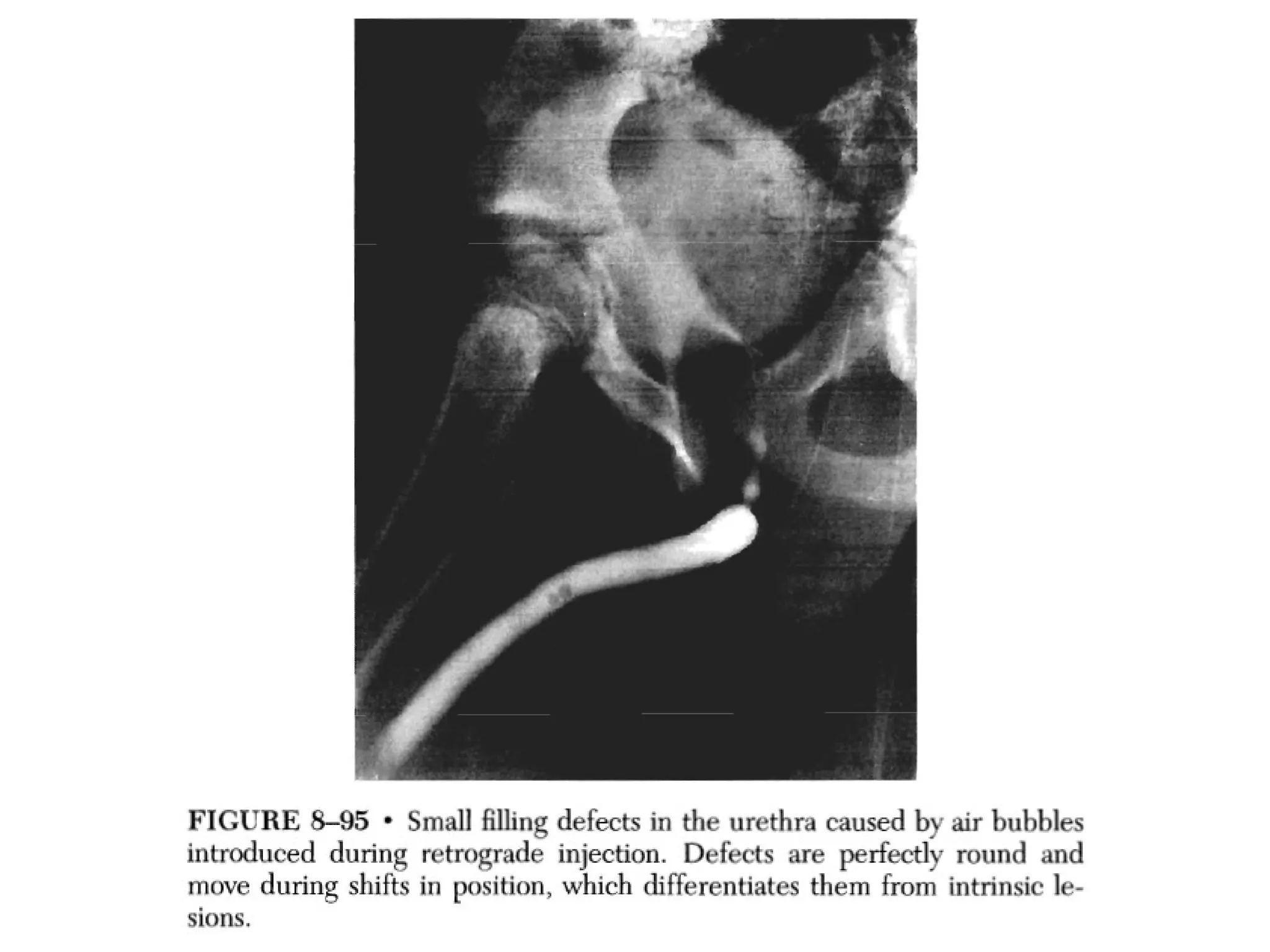 retrograde urethrogram presentation 1 ppt | PPTX