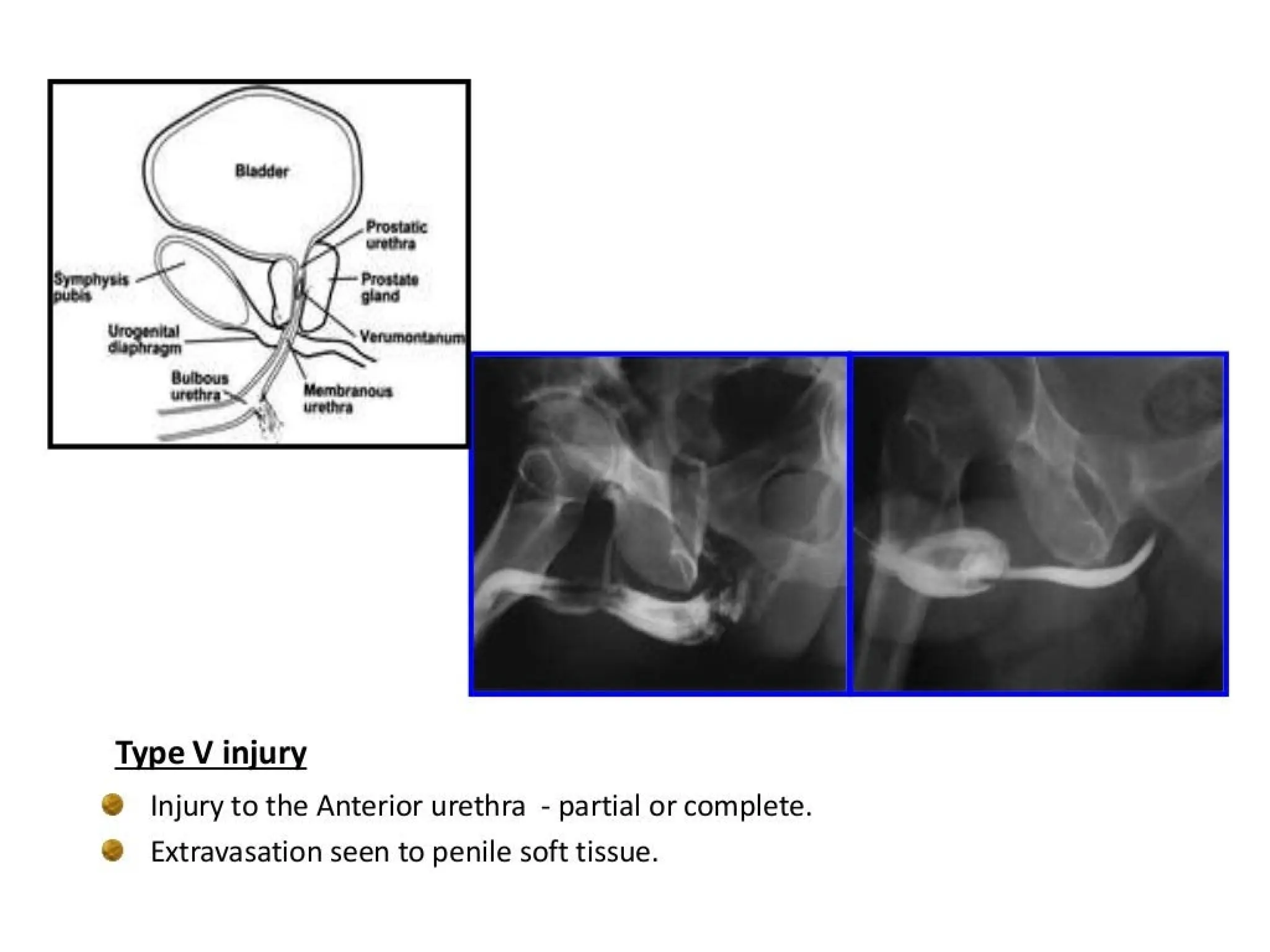 retrograde urethrogram presentation 1 ppt | PPTX