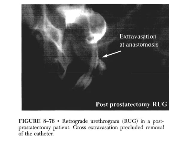 retrograde urethrogram presentation 1 ppt | PPTX
