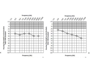 3.Configurations of Audiogram - Copy.pptx