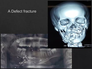 3. Classification of Maxillofacial Trauma 5th year.pptx