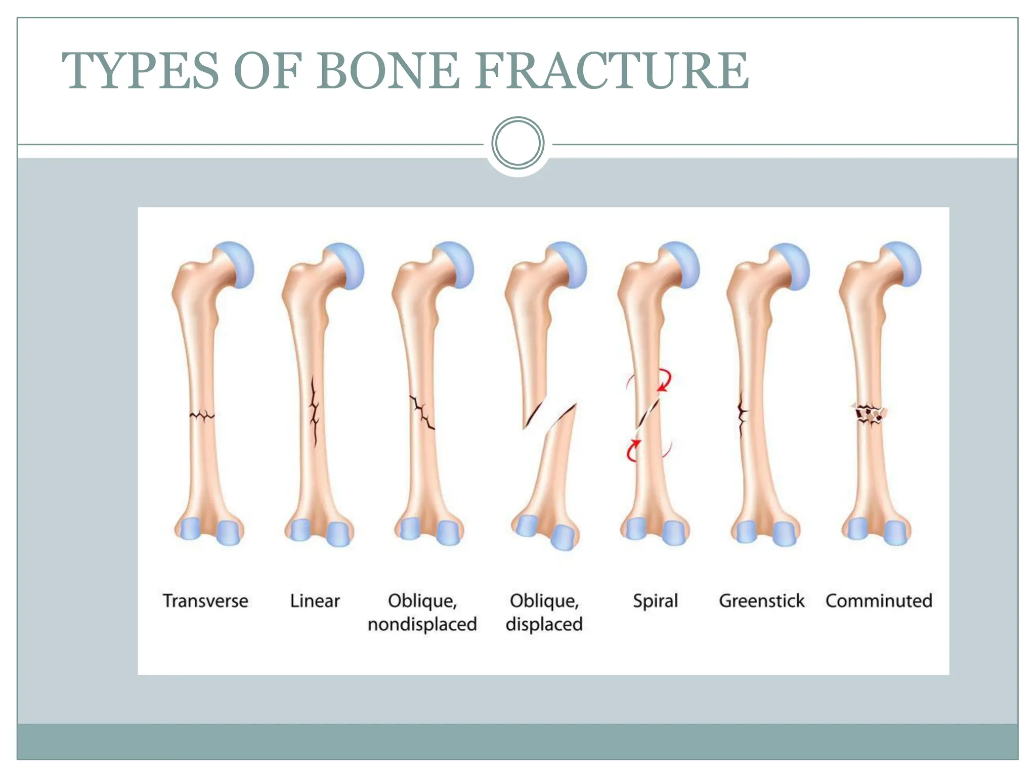 bone fracture and it's types in biomechanics | PDF