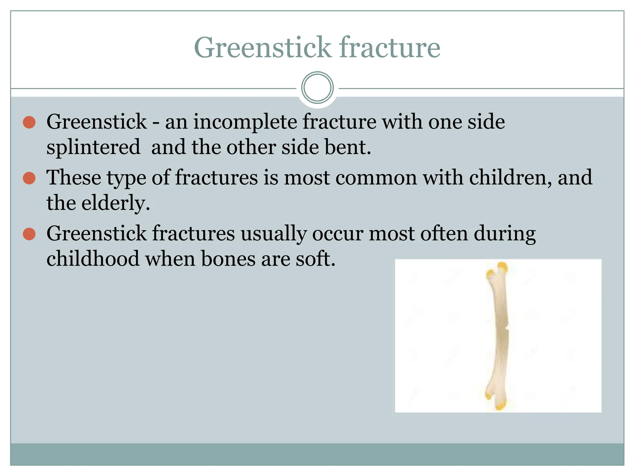 bone fracture and it's types in biomechanics | PDF