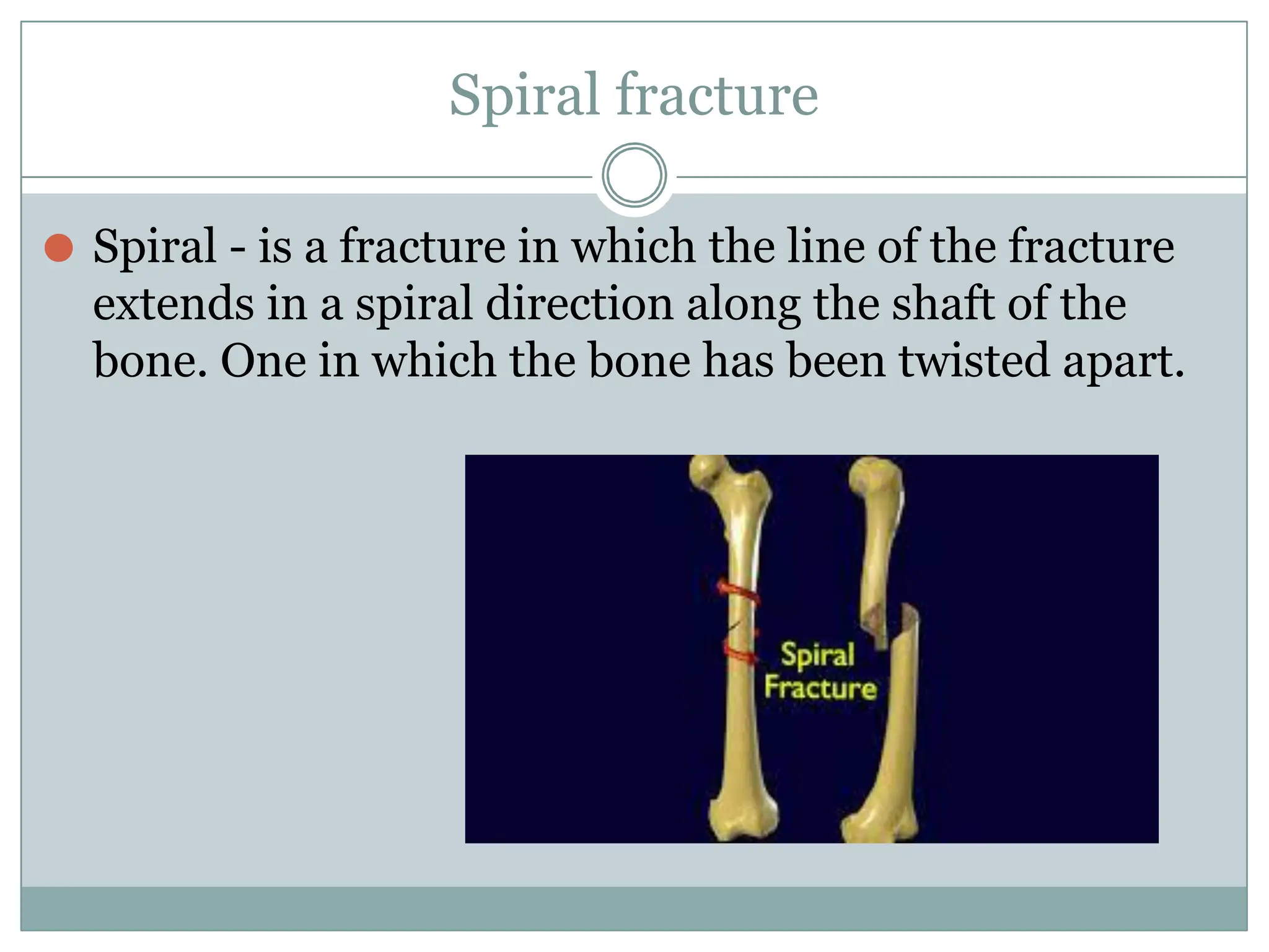 bone fracture and it's types in biomechanics | PDF
