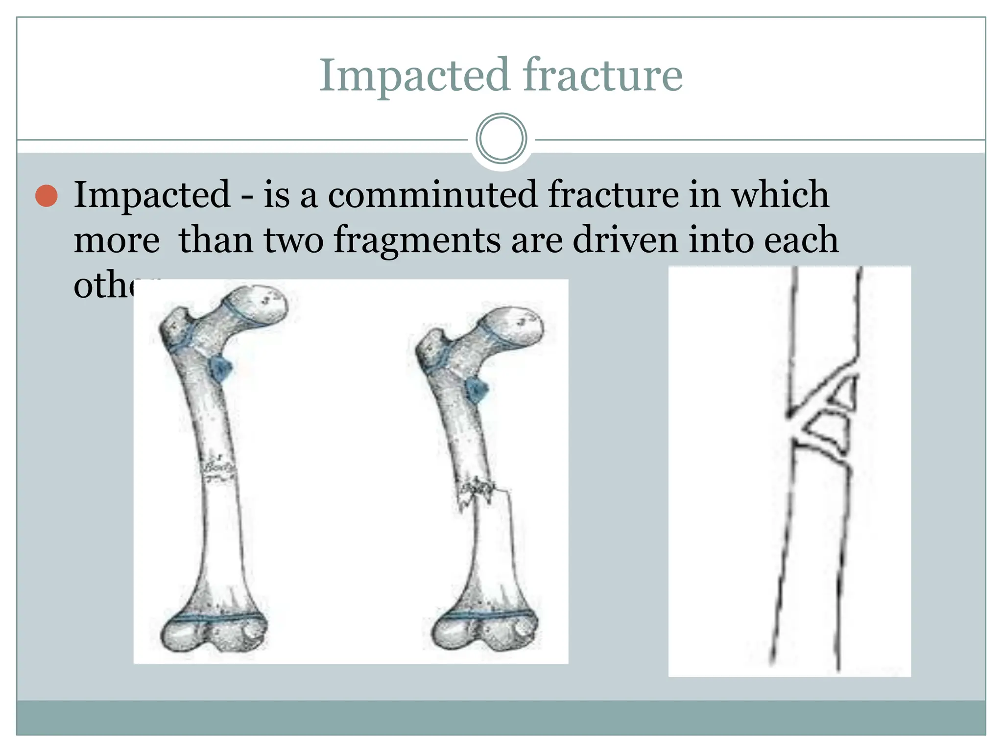 bone fracture and it's types in biomechanics | PDF