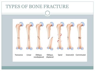 bone fracture and it's types in biomechanics | PDF