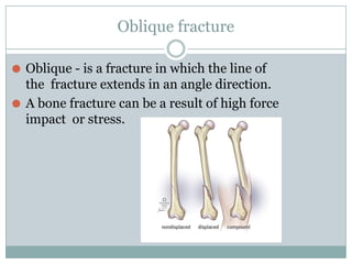 bone fracture and it's types in biomechanics | PDF