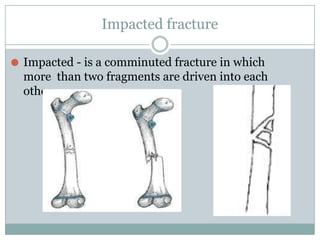 bone fracture and it's types in biomechanics | PDF