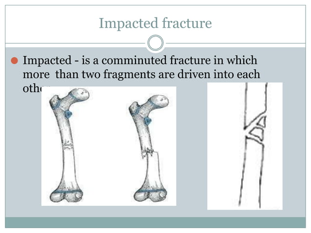 bone fracture and it's types in biomechanics | PPT