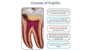 3. etiology/ DENTAL PULP, PULP CHARACTHERISTICS | PPT