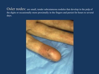 3. Infective Endocarditis.pptwhith good explanation | PPT
