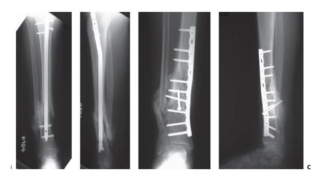 3.Fracture healing.iiiiiiiiiiiiiiiiipptx | PPT