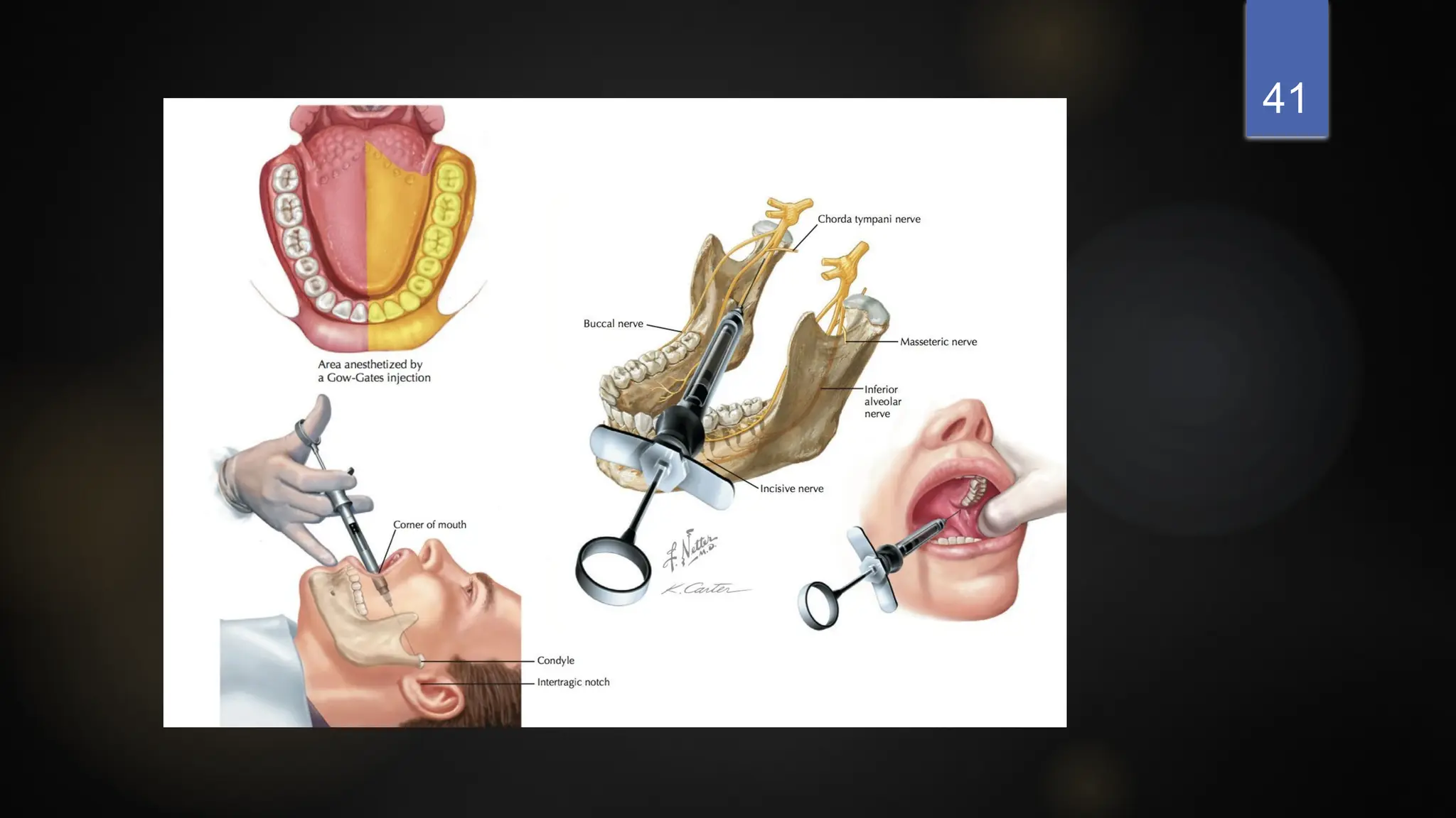 3.local anesthesia in dentistry pptx presentation | PPTX