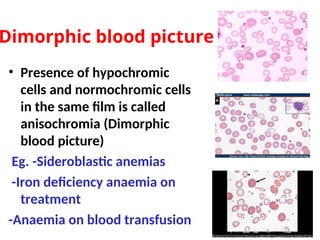 3.-Anemia-IDA.ppt iron deficiency essentials | PPT