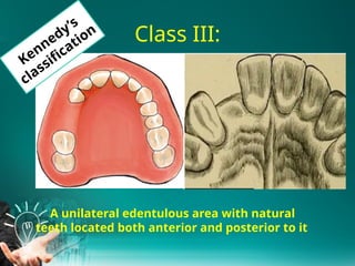 3.Principles of kennedy class III IV RPD design2025.pptx