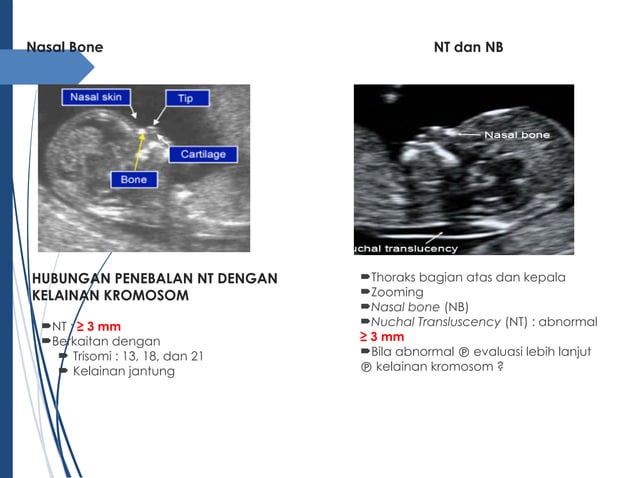 3.e USG Obstetri trimester 1 patologi 2.pptx