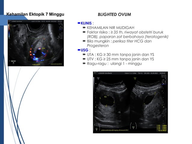 3.e USG Obstetri trimester 1 patologi 2.pptx