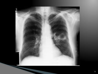 3. Diagnosis & Management of Lung Abscess.pptx