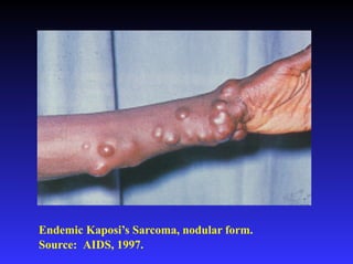 3. Infeksi Virus (mumps, morbili, varicella, Herpes zoster ...